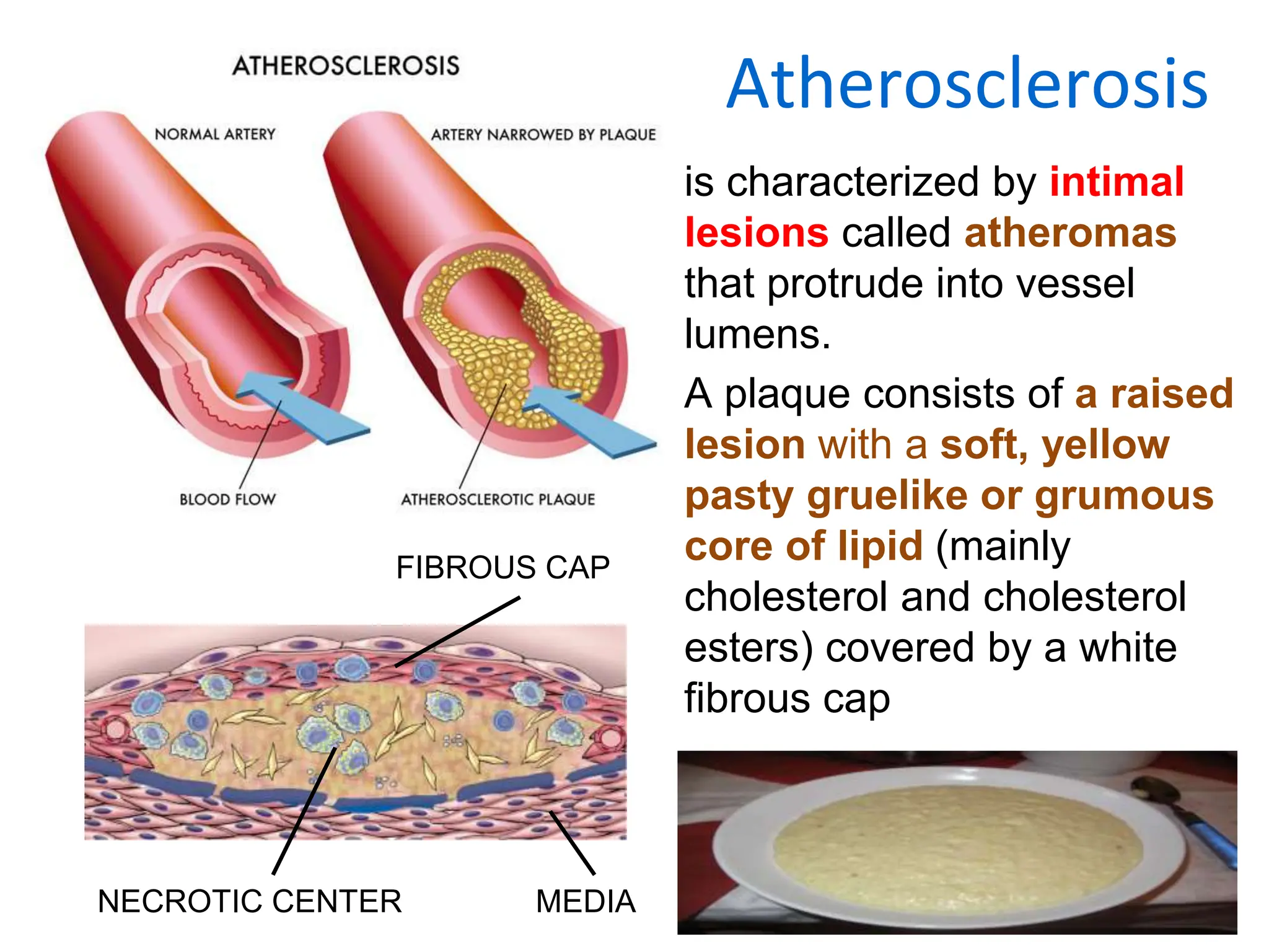17970_27.1Atherosclerosis.pptx