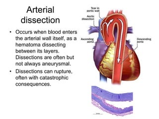 17971_27.2_Aneurysm.ppt