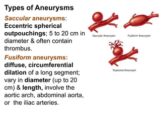 17971_27.2_Aneurysm.ppt