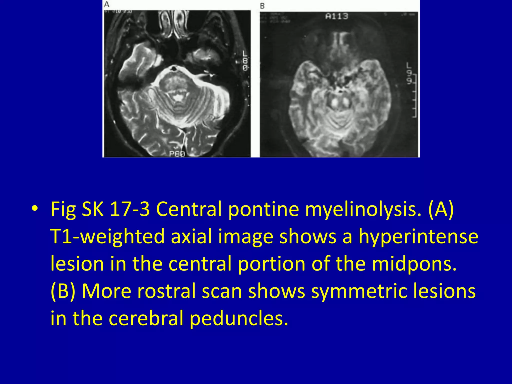 17 brainstem lesions on magnetic resonance imaging | PPT
