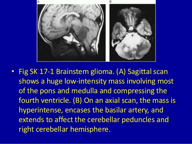 17 brainstem lesions on magnetic resonance imaging