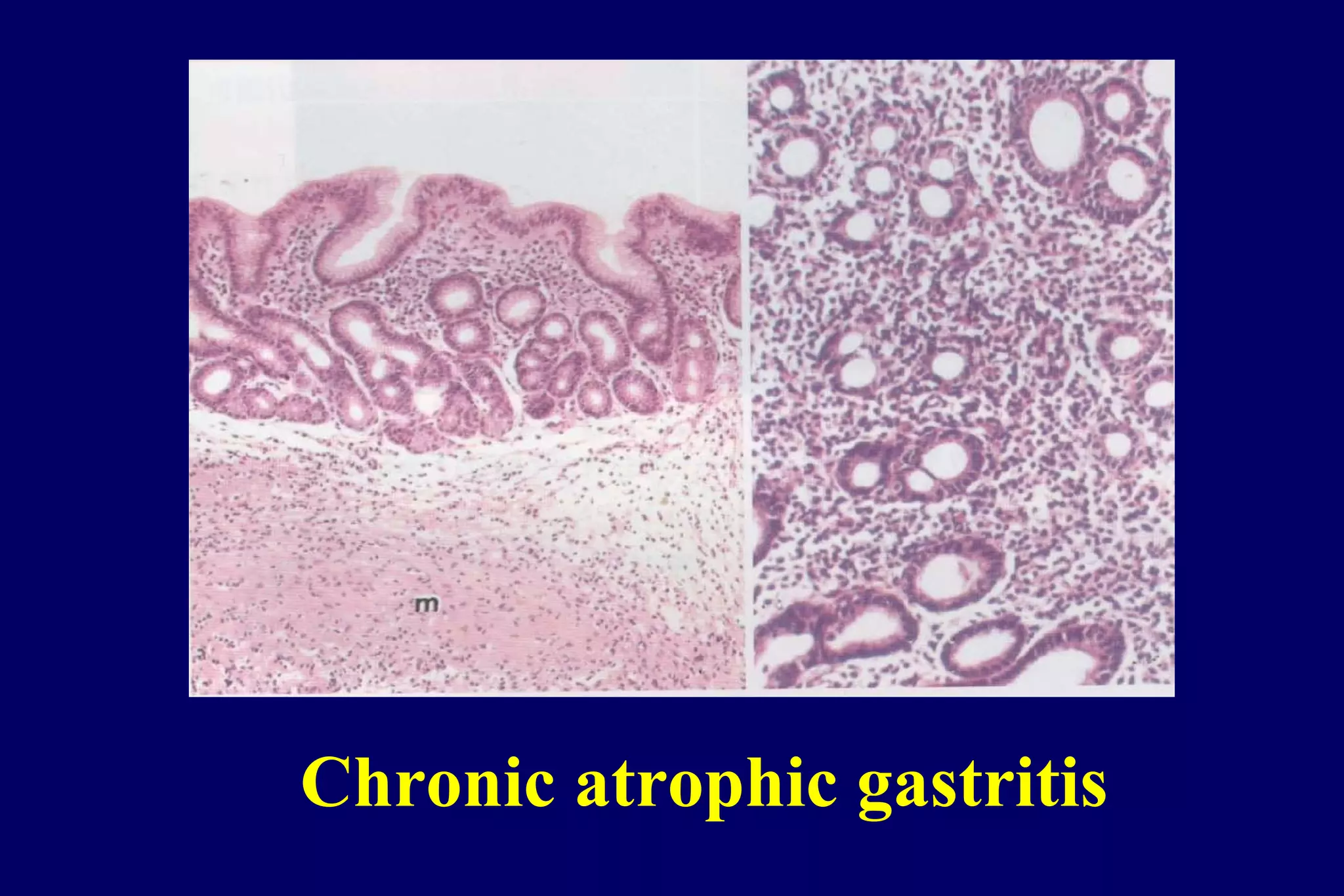 17 chronic gastritis gao | PPT