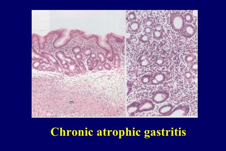 17 chronic gastritis gao