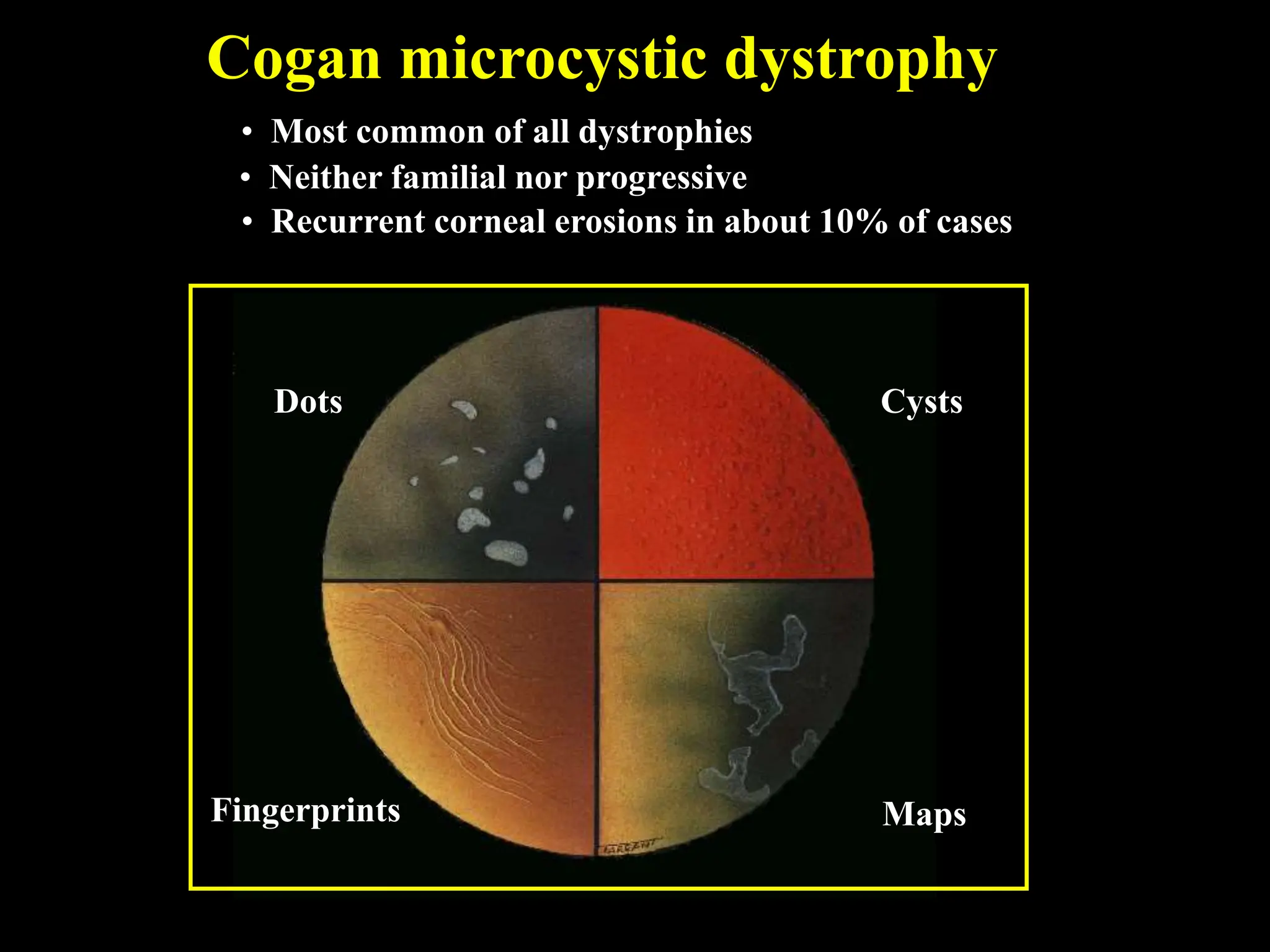 Corneal Dystrophies.ppt
