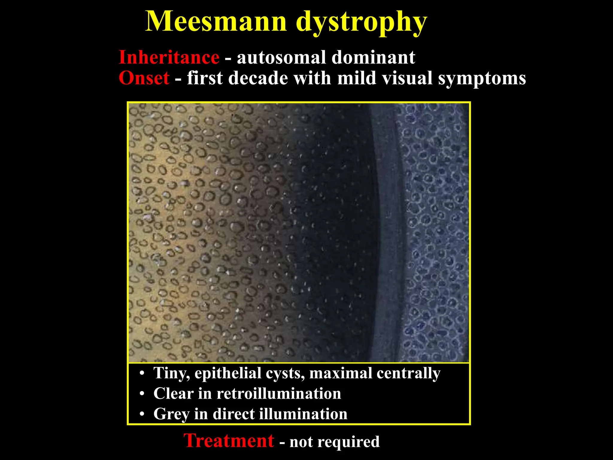 Corneal Dystrophies.ppt