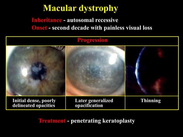 Corneal Dystrophies.ppt