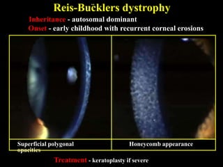 Corneal Dystrophies.ppt