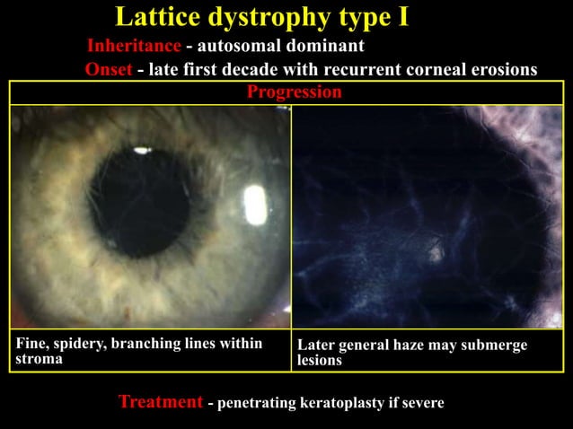Corneal Dystrophies Ppt