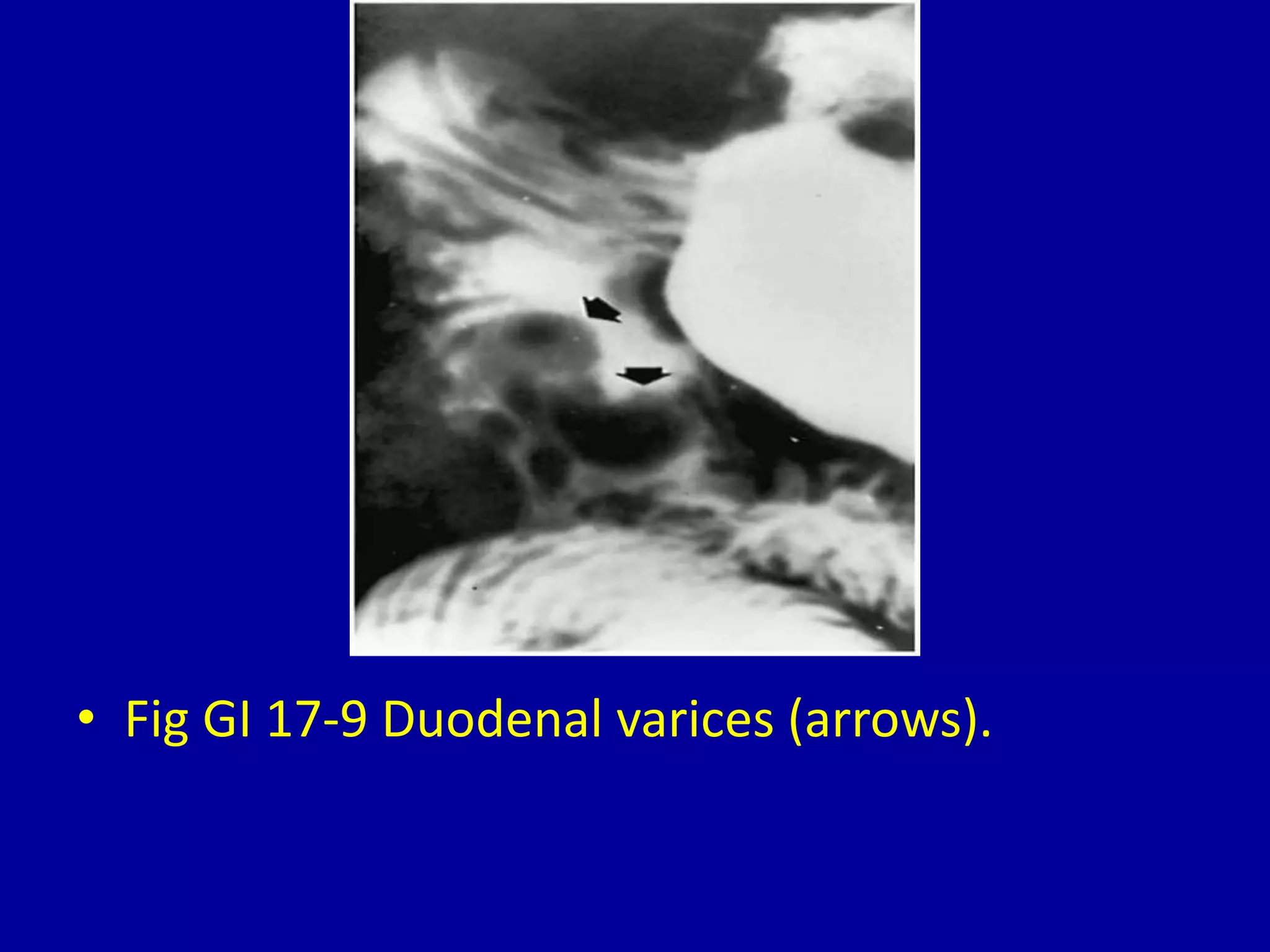 17 duodenal filling defects | PPTX
