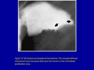 17 duodenal filling defects | PPTX
