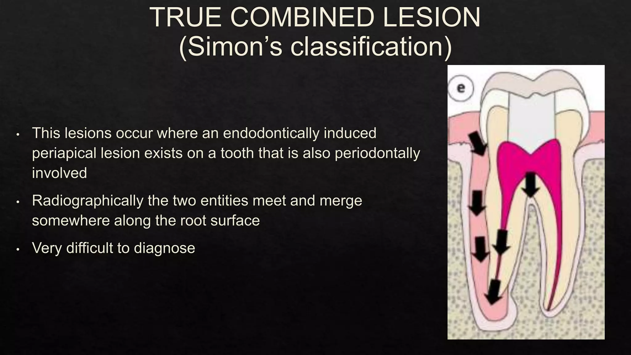 ENDO-PERIO LESIONS | PPTX