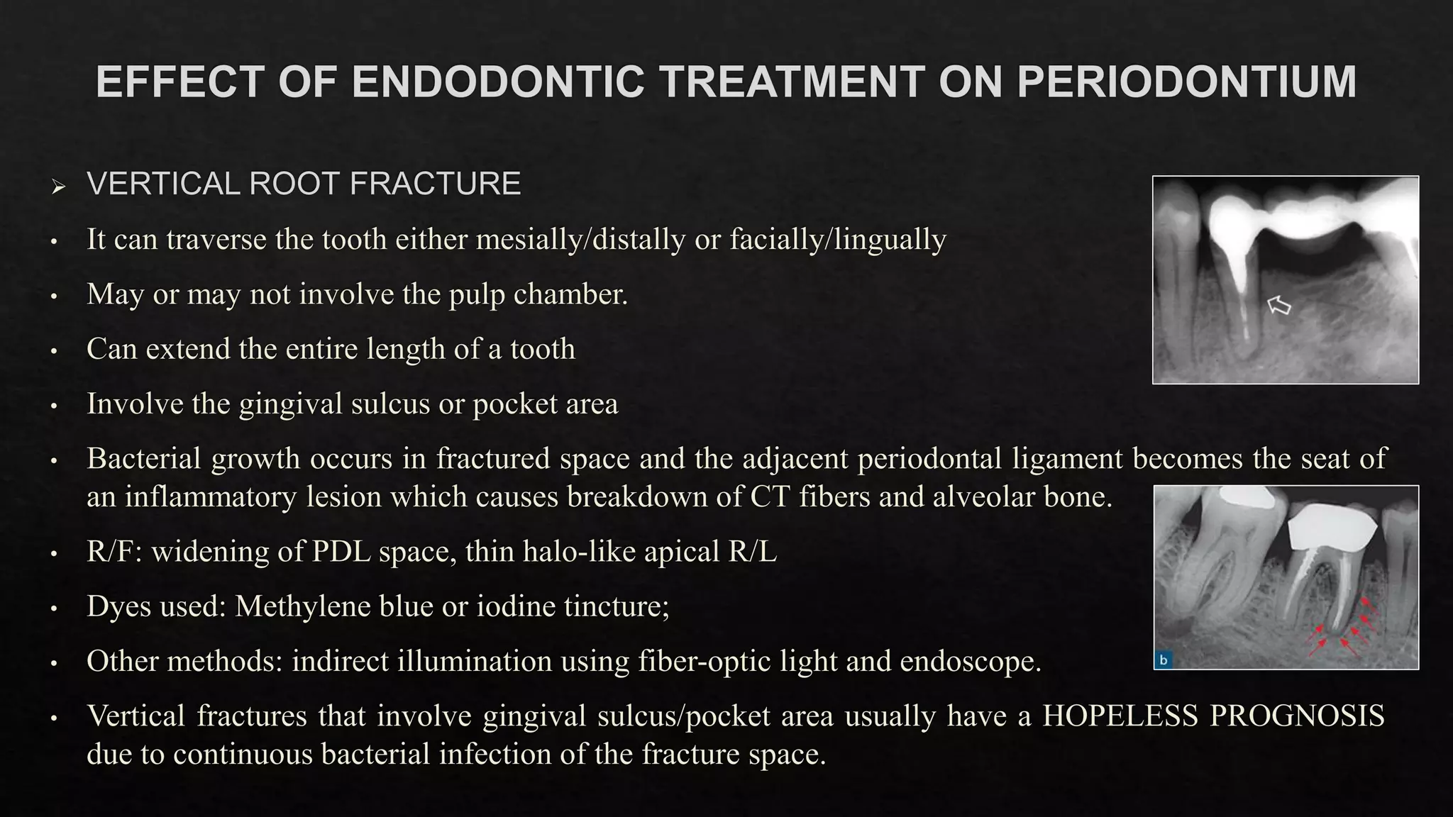 ENDO-PERIO LESIONS | PPTX