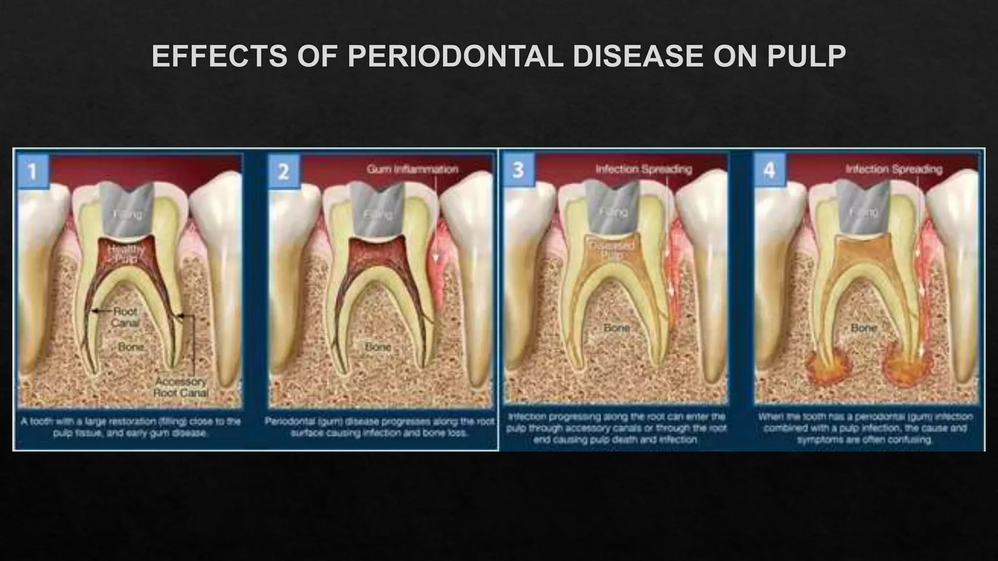 ENDO-PERIO LESIONS | PPTX