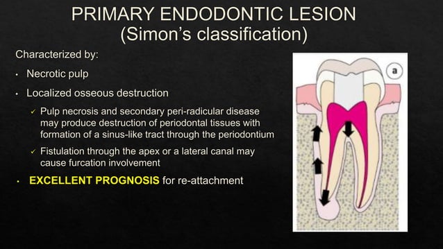 ENDO-PERIO LESIONS | PPTX | Dental Health | Diseases and Conditions