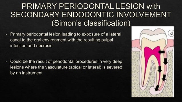 ENDO-PERIO LESIONS | PPTX | Dental Health | Diseases and Conditions