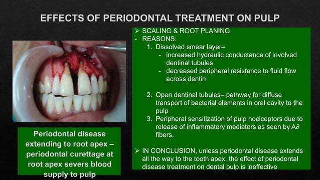 ENDO-PERIO LESIONS | PPTX | Dental Health | Diseases and Conditions