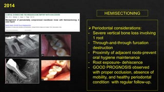 ENDO-PERIO LESIONS | PPTX