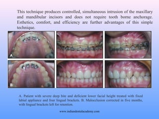 lingual bracket | PPT | Dental Health | Diseases and Conditions