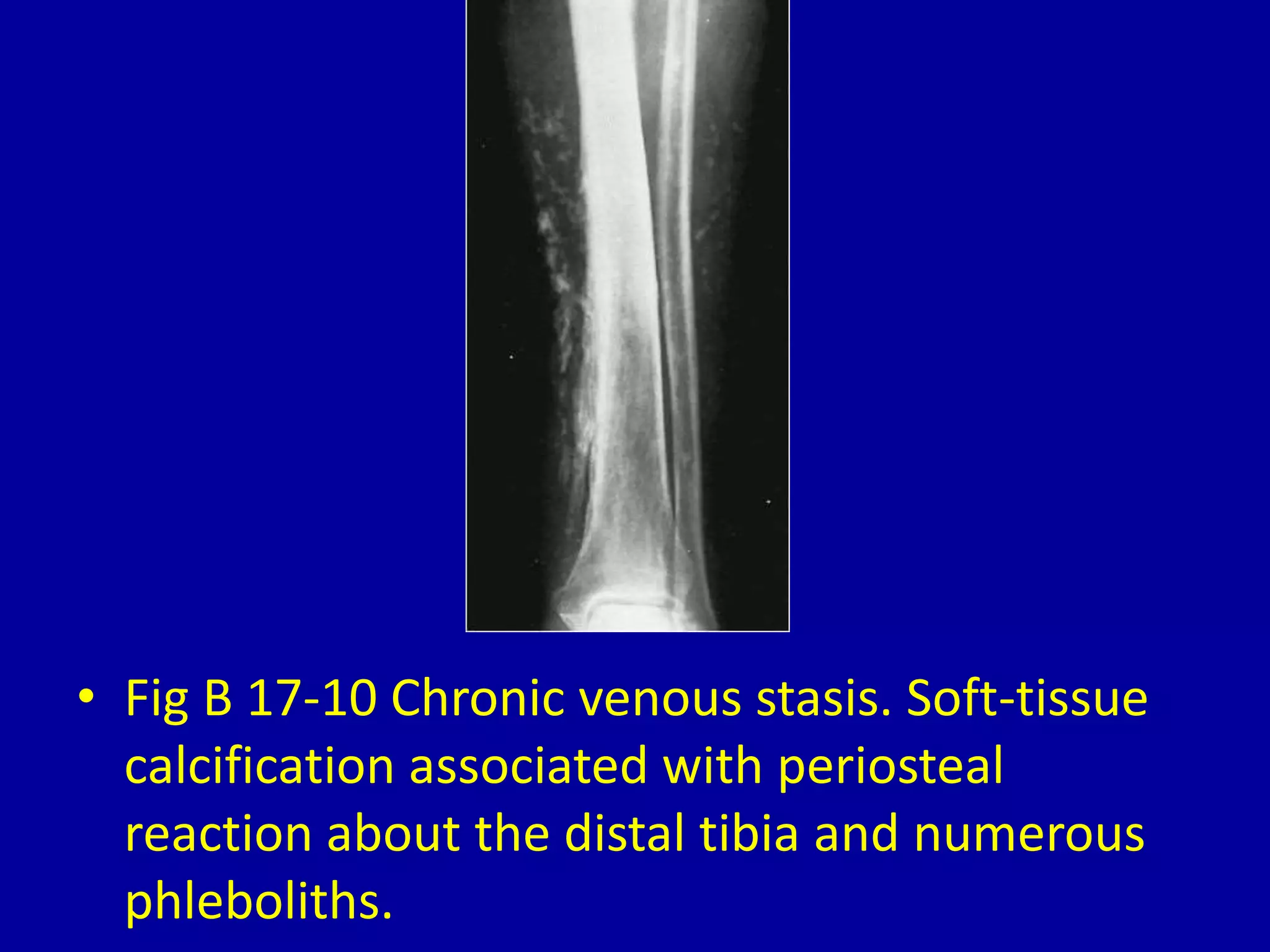 17 Localized Calcification Or Ossification In Muscles And Ppt