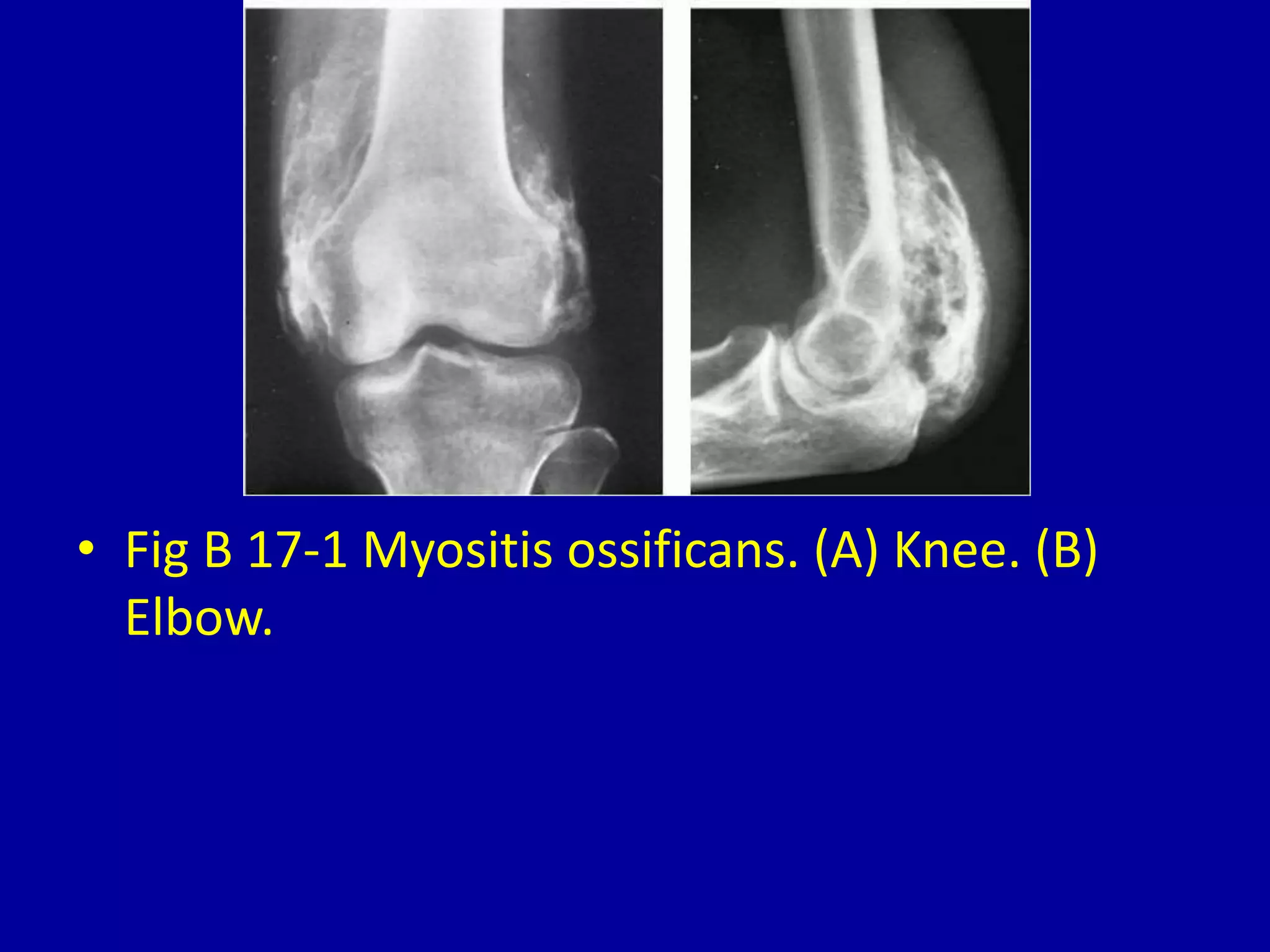 17 Localized Calcification Or Ossification In Muscles And Ppt Free Download