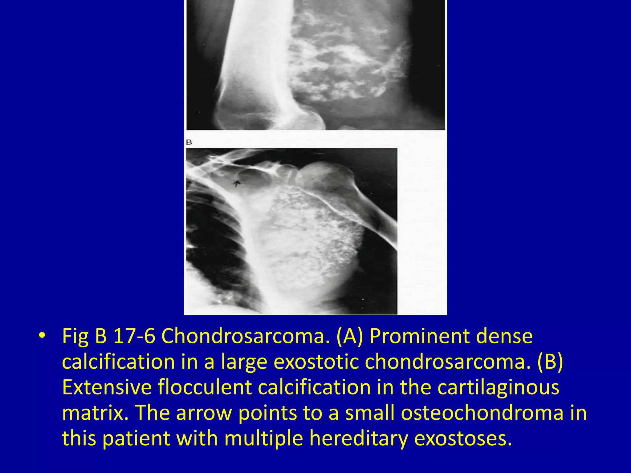 17 Localized Calcification Or Ossification In Muscles And Ppt
