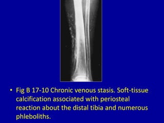 17 localized calcification or ossification in muscles and | PPT