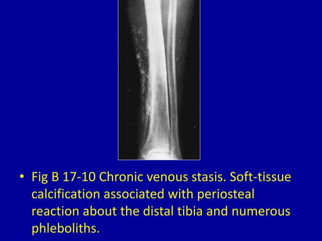 17 localized calcification or ossification in muscles and | PPT
