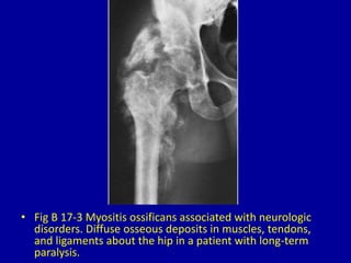 17 localized calcification or ossification in muscles and | PPT