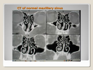 Maxillary Sinus | PPT