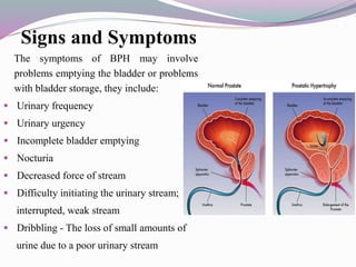 Benign Prostate Hypertrophy | PPTX
