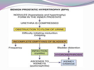 Benign Prostate Hypertrophy | PPTX