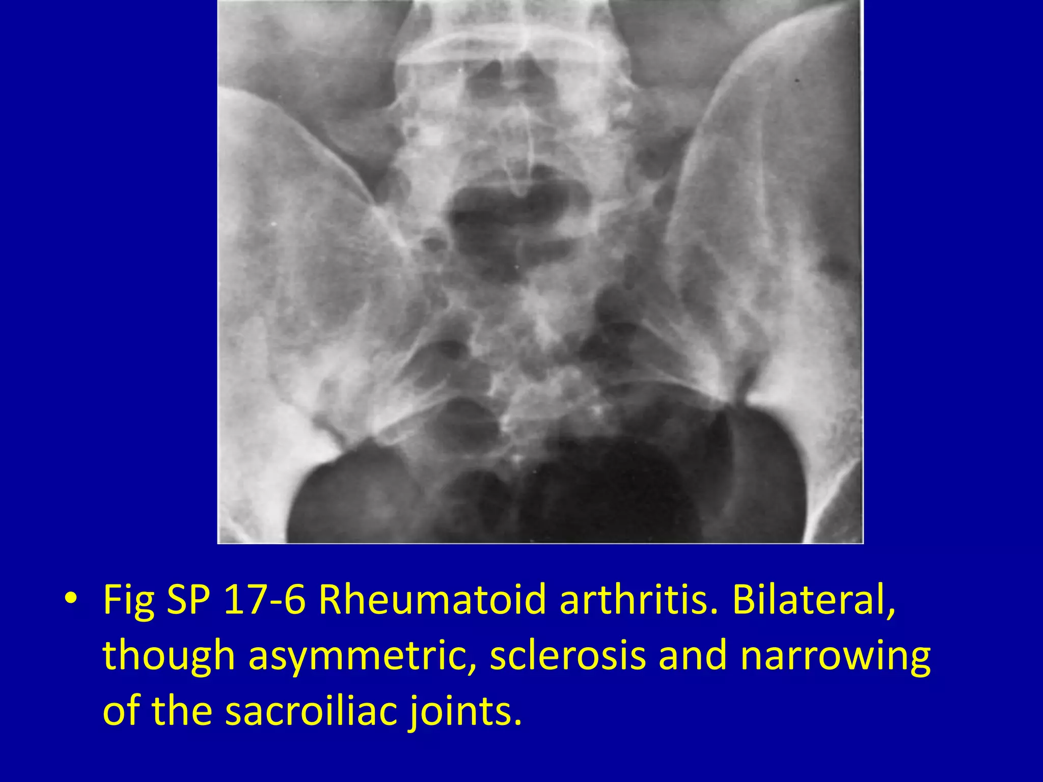 17 sacroiliac joint abnormality | PPT