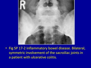17 sacroiliac joint abnormality | PPT