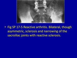 17 sacroiliac joint abnormality | PPTX