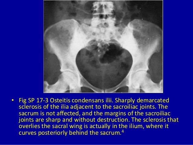 17 sacroiliac joint abnormality