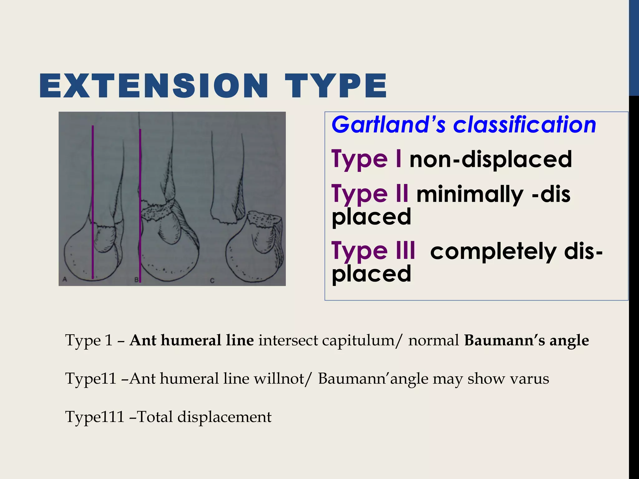 supra condylar fracture humerus | PPT