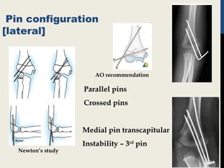 supra condylar fracture humerus | PPT