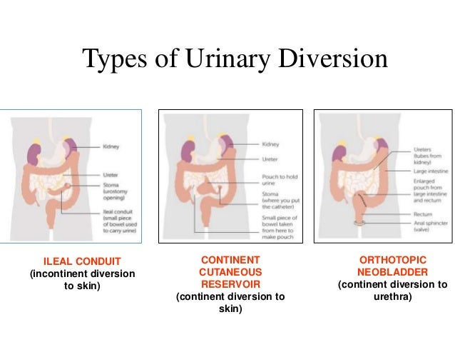 carcinoma urinary bladder management