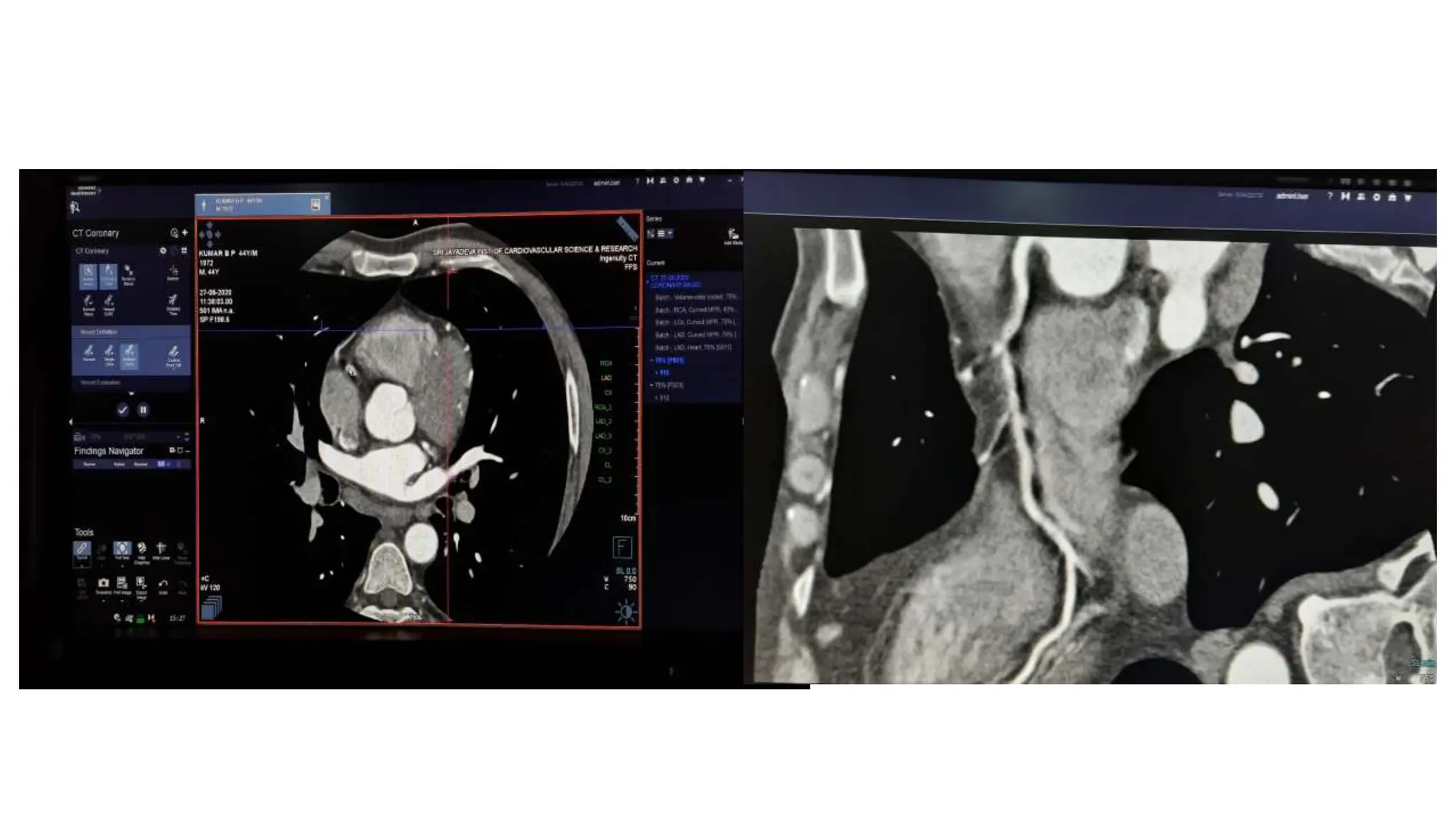 18-09-2020 CT CORONARY ANGIOGRAM Dr.Sowmya.Dr.BGJ.pptx.pptx