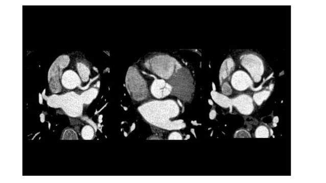 18-09-2020 CT CORONARY ANGIOGRAM Dr.Sowmya.Dr.BGJ.pptx.pptx
