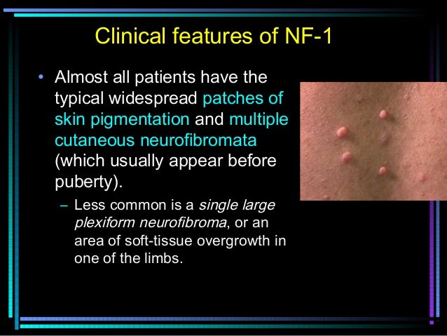 18. neurofibromatosis muhammad abdelghani