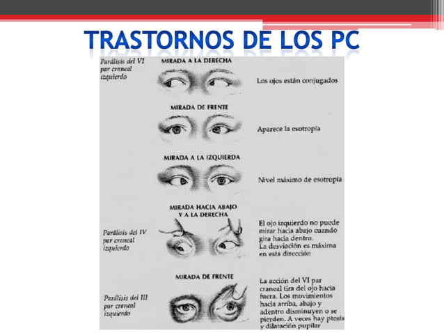18. Anomalias de Ojo (02-Oct-2013) | PPTX | Eye and Vision Conditions ...
