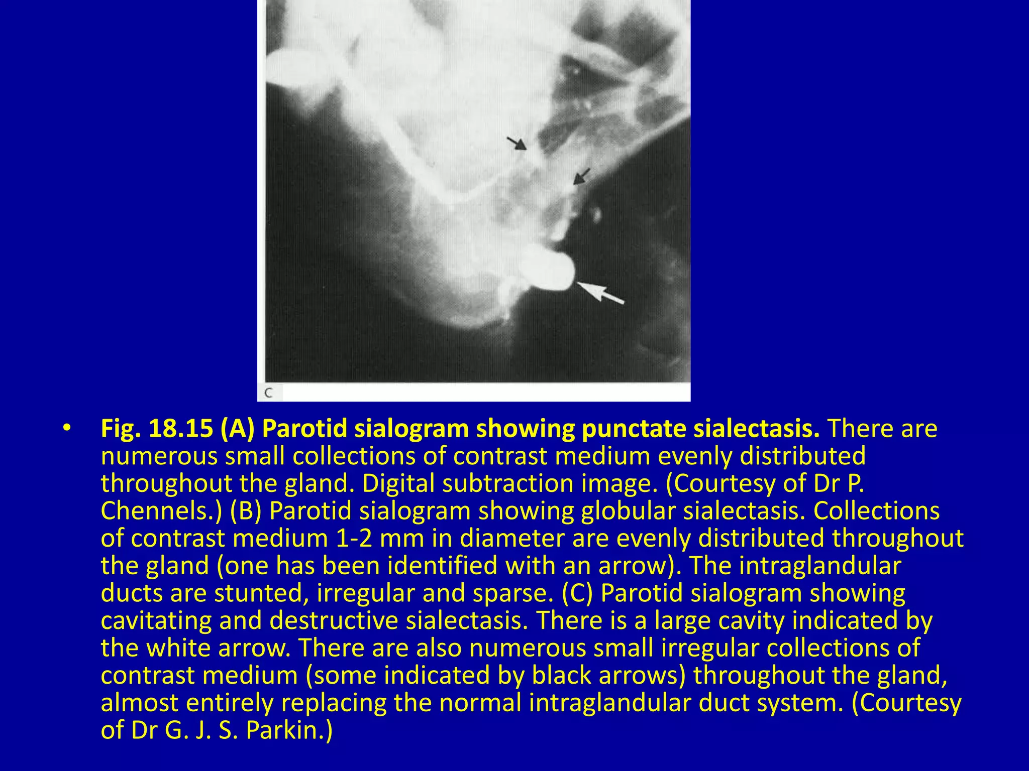 18 DAVID SUTTON PICTURES THE SALIVARY GLANDS PHARYNX AND ESOPHAGUS | PPTX