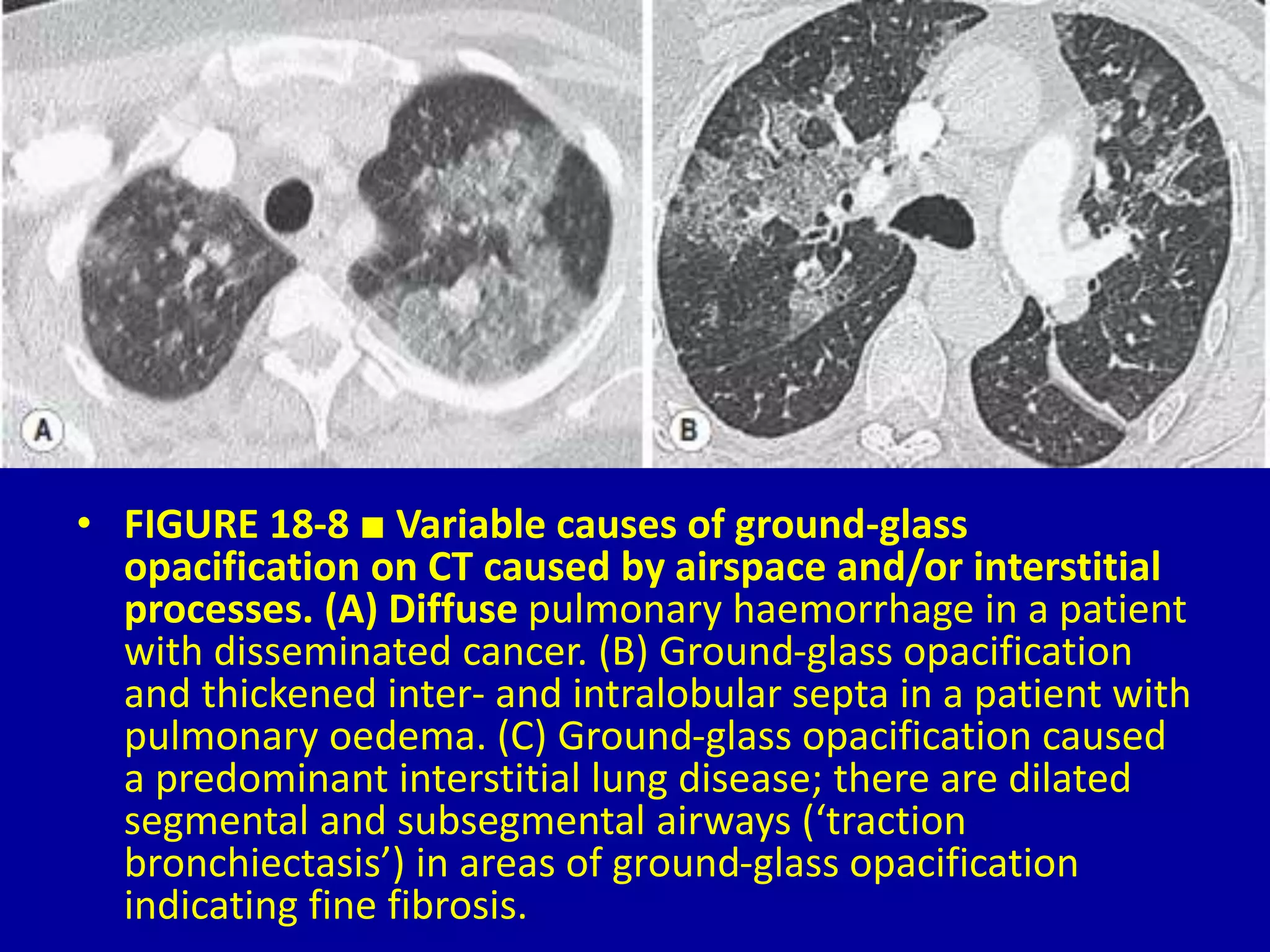 18 Airspace Diseases Dr. Muhammad Bin Zulfiqar | PPTX
