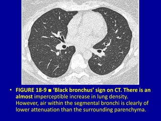 18 Airspace Diseases Dr. Muhammad Bin Zulfiqar | PPT