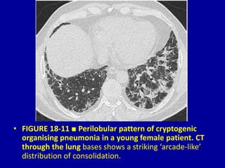 18 Airspace Diseases Dr. Muhammad Bin Zulfiqar | PPTX