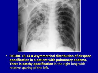 18 Airspace Diseases Dr. Muhammad Bin Zulfiqar | PPTX