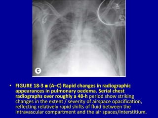18 Airspace Diseases Dr. Muhammad Bin Zulfiqar | PPTX