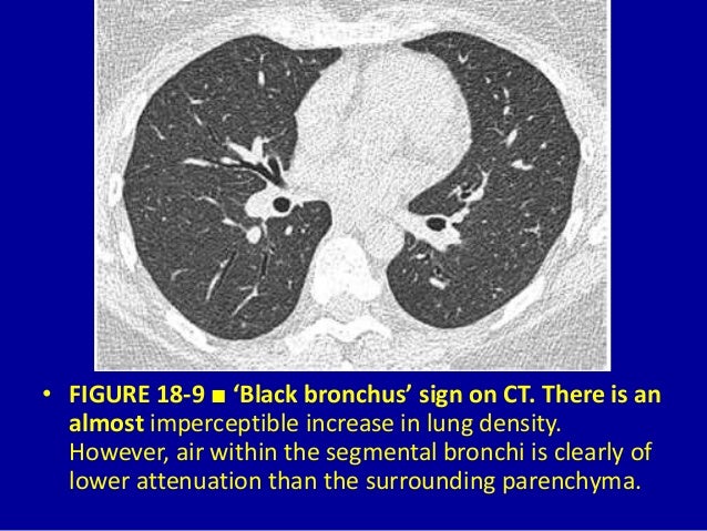 18 Airspace Diseases Dr. Muhammad Bin Zulfiqar