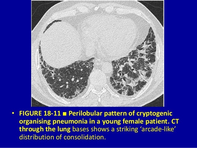 18 Airspace Diseases Dr. Muhammad Bin Zulfiqar